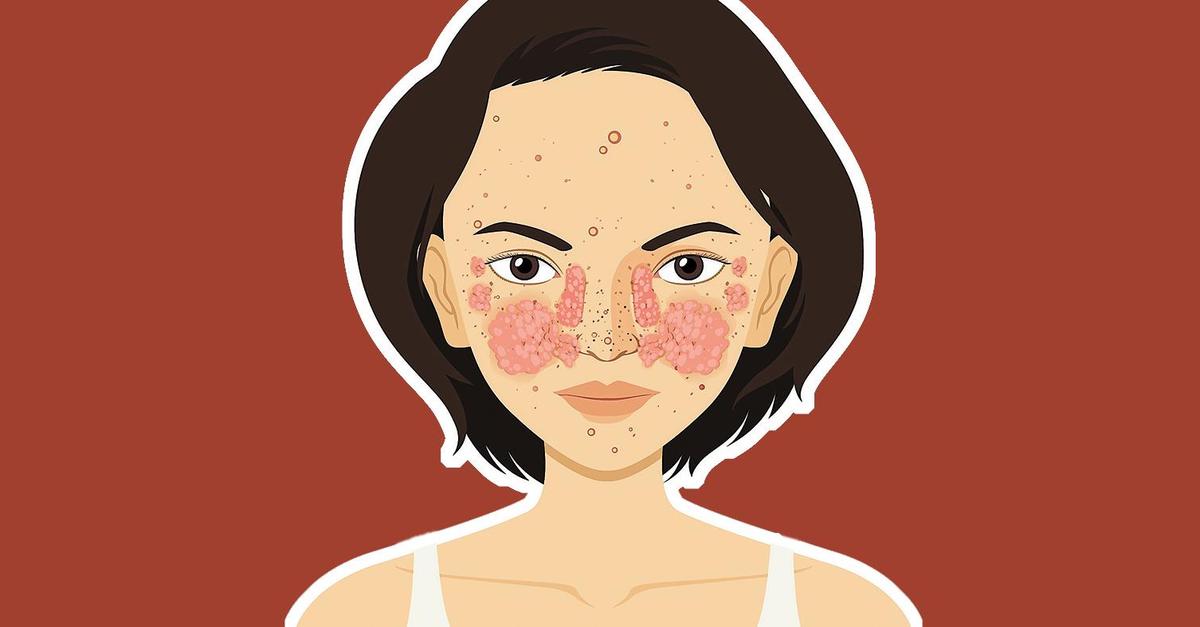 Autoimmunkrankheit Lupus: Patientin berichtet von neuer Therapie
